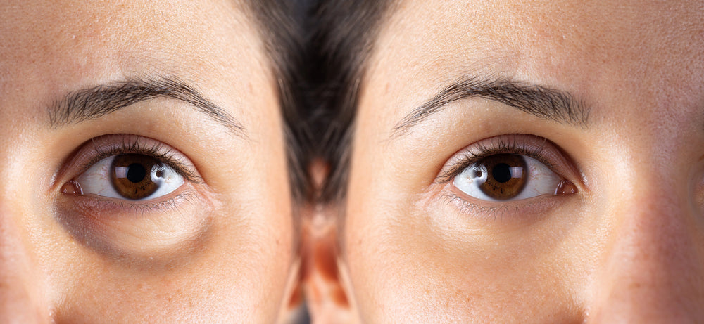 How to Tighten and Firm the Skin Around Your Eyes – High End Beauty